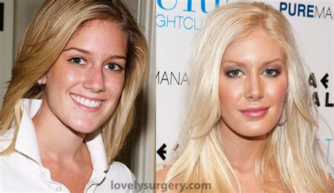 Total Transformation Of Heidi Montag Lovely Surgery Celebrity
