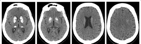 Non Enhanced Axial Ct Sections Demonstrating Bilateral Nearly Download Scientific Diagram