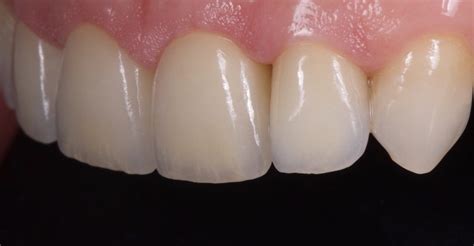 Discolored Teeth Oral Design Fogtechnikai Labor 1995 óta A