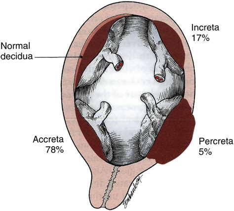 Creating A Multidisciplinary Placenta Accreta Program Nursing For