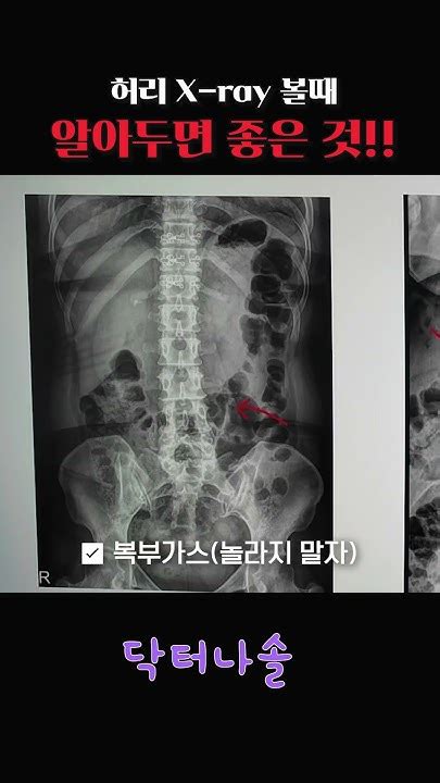 엑스레이 보는 법 가짜 정보에 놀라지 말자 허리 엑스레이 허리통증 허리디스크 허리협착증 Youtube