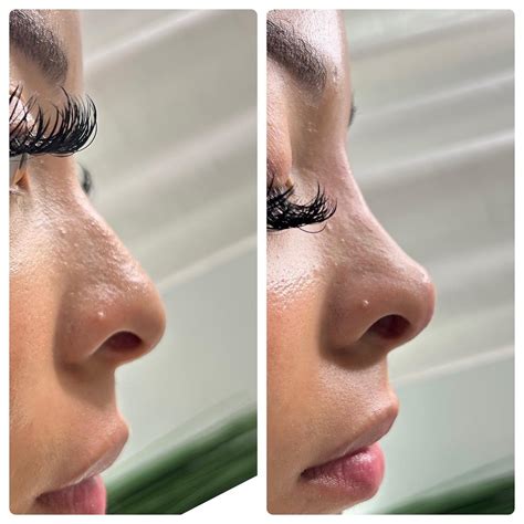 💉cute Pixie Lift Creating A Dee Aesthetics Lab X