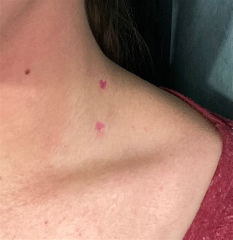 Как выглядят увеличенные надключичные лимфоузлы фото