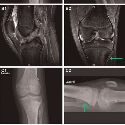 A Evidence Of Osteoblastic Type Osteosarcoma In The Proximal Tibia Download Scientific