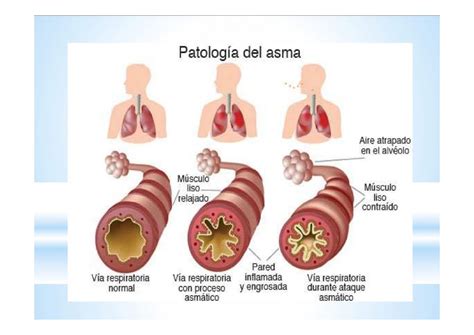 Alergias Y Asma Mas Vida
