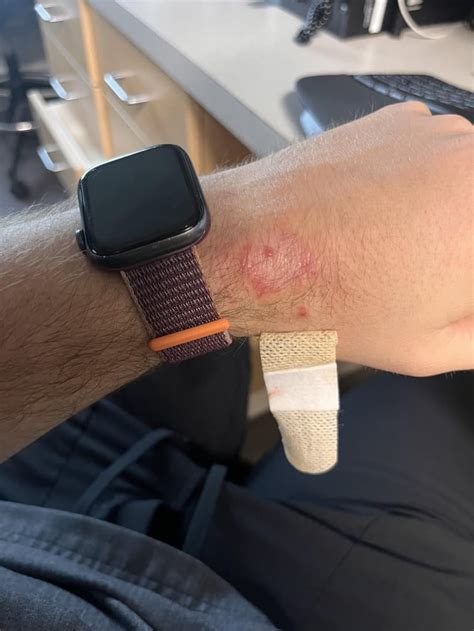 Ringworm Insect Bite Something Else R Dermatology