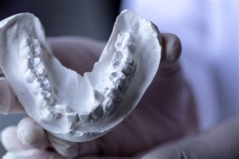 연구 진단 캐스트 및 치과 실험실에서 치과 석고 모델의 캐스팅 건강 진단에 대한 스톡 사진 및 기타 이미지 건강 진단 건강