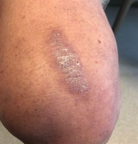 Itchy Scaly Patches Clinical Advisor
