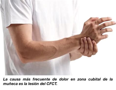 Lesión Del Fibrocartílago Triangular Synergia