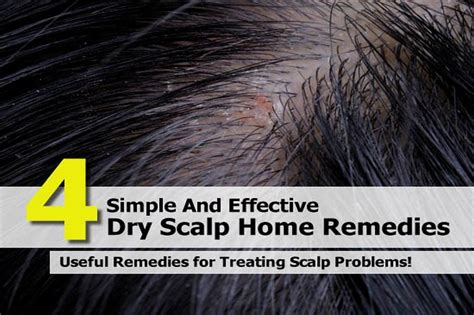 At Home Scalp Treatment At Shirley Vining Blog