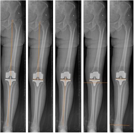 A Hip‐knee‐ankle Angle Hka B Lateral Distal Femoral Angle