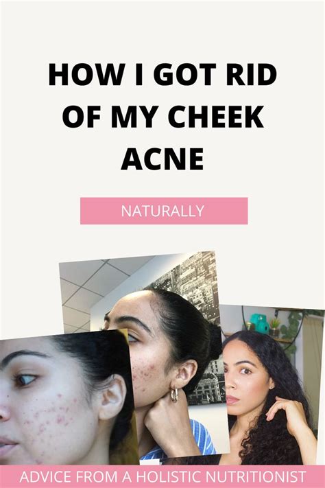 How To Get Rid Of Cheek Acne Naturally Cheek Acne Cheek Pimples Cheek