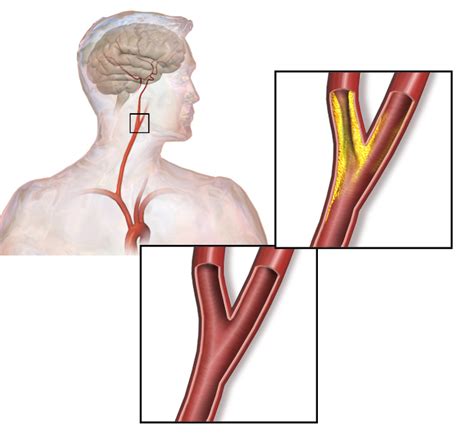 Carotid Artery Stenosis Concise Medical Knowledge