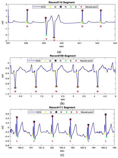 A Qrs Detection And R Point Recognition Method For Wearable Single Lead Ecg Devices