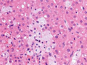Hepatic And Pancreatobiliary Pathology Cleveland Clinic Laboratories