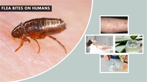 Flea Bites On Humans Symptomstreatment Pictures