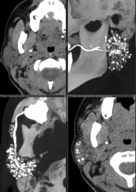 Ilson Sepulveda A Bds Msc On Linkedin Ct Sialogram Ct Head S W W O Contrast Mip After