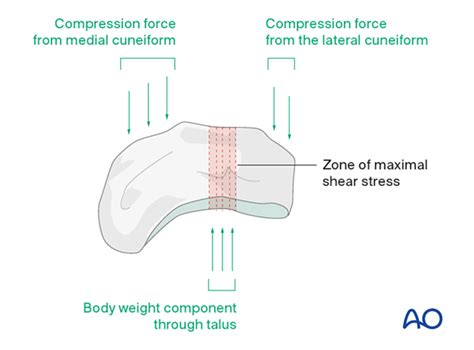 Nonoperative Treatment For Partial Articular Navicular Fracture