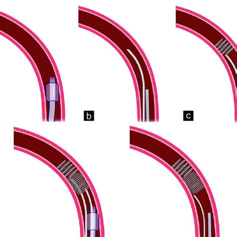 Dual Microcatheter Balloon Occlusion Coiling Technique A Step 1