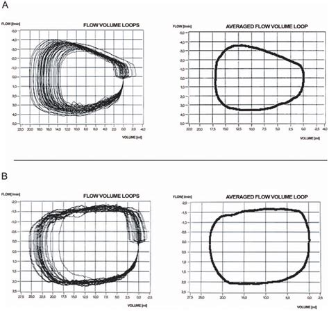 Consecutively Measured Tidal Breathing Flow Volume Loops Of Newborns Download Scientific