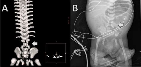 Segmental Spinal Dysgenesis Ochsner Journal