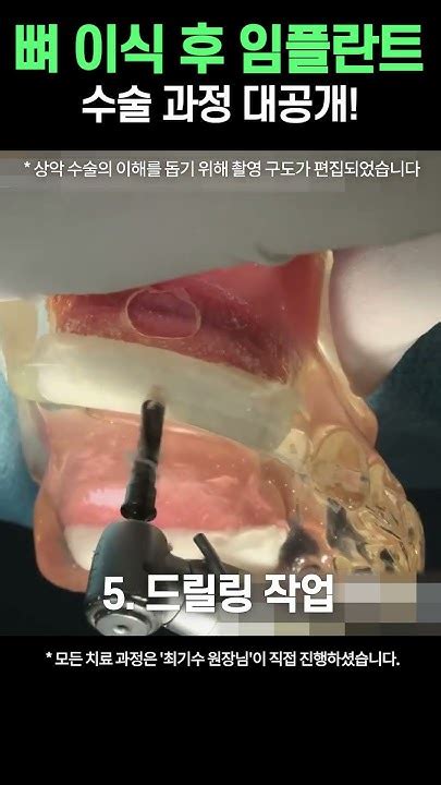 뼈 이식 임플란트의 전 과정 직접 눈으로 확인하세요 Shorts Youtube