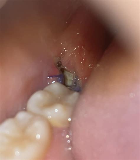 Extracted Wisdom Tooth Operation Day 6 Raskdentists