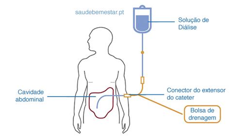 Diálise Peritoneal O Que é Como Funciona Indicações