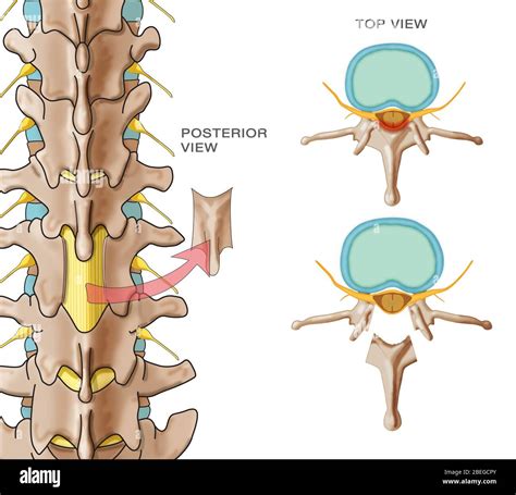 Foraminotomy Vs Laminectomy