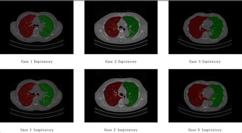 Figure 1 From Acute Exacerbation Prediction Of Copd Based On Auto Metric Graph Neural Network