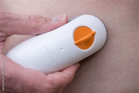 Sydney Australia 2022 07 31 Cgm Continuous Glucose Monitoring Dexcom G6 Sensor