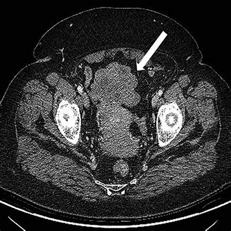 Contrast Ct Showing Multiple Lobulated Enhancing Jejunal Mesenteric
