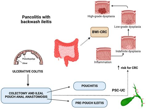 Ileitis Humpathcom Human Pathology
