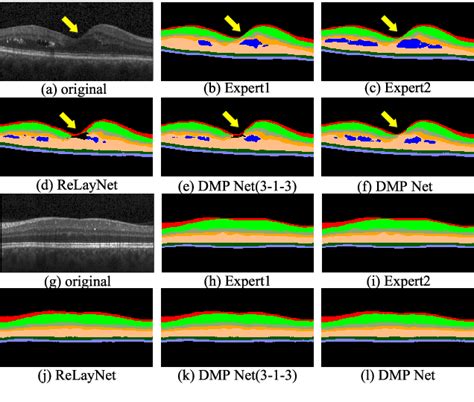 Figure 9 From The Segmentation Of Retinal Layer And Fluid In Sd Oct Images Using Mutex Dice Loss