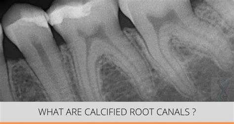 What Are Calcified Or Blocked Root Canals Expert Dental Care