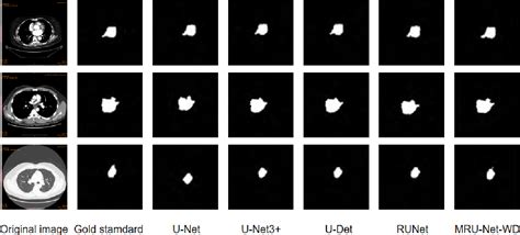 Figure 1 From Segmentation Of Pulmonary Nodules Based On Mrbu Net Wd Model Semantic Scholar