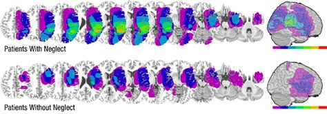 Figure 1 From Patients With Left Spatial Neglect Also Neglect The Left