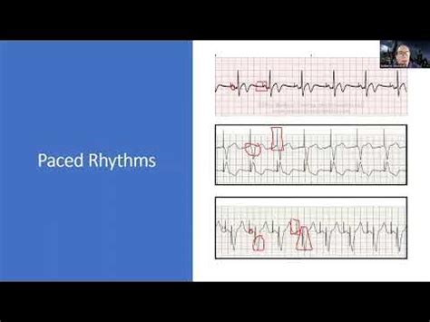 Adult Med Surg Dysrhythmia New Lecture Paced Rhythms Youtube