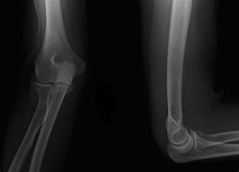 Radial Head Fracture Treatment And Recovery Tips Sport Doctor London