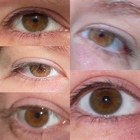 What Color Ch R Heterochromia
