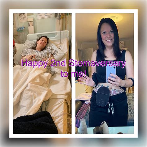 2 Yrs Post Stoma Surgery And JPouch Excision With Total Proctectomy