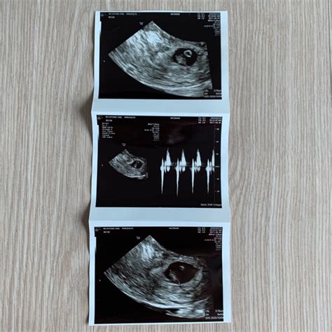 [임신 6주차] 보건소 임산부 등록 산전검사 정상 임산부 영양제 네이버 블로그