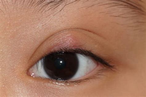 Cysts On Eyelids Chalazia And Other Common Causes Explained