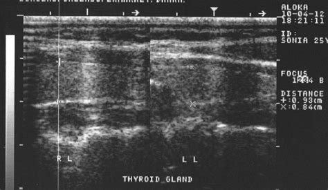 Longitudinal Sections Of Thyroid Lobes For Anteroposterior Measurements