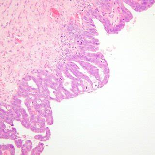 Serous EIC Showing High Grade Nuclear Cytology Abbreviation EIC Download Scientific Diagram