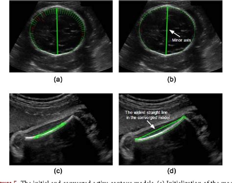 Figure 1 From Automatic Detection And Measurement Of Fetal Biparietal