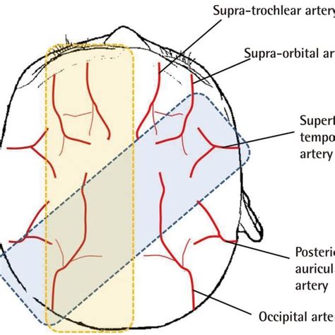 Pdf Vascularized Bipedicled Pericranial Flaps For Reconstruction Of Chronic Scalp Ulcer