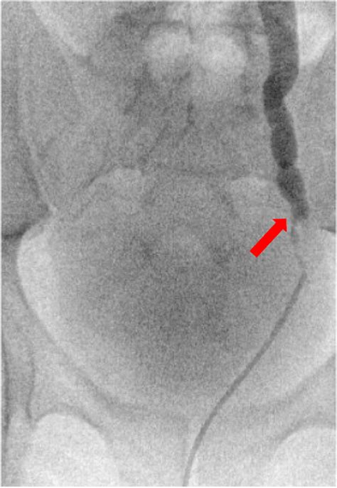 Left Retrograde Pyelogram Revealing Stenosis Of The Left Distal Ureter Download Scientific