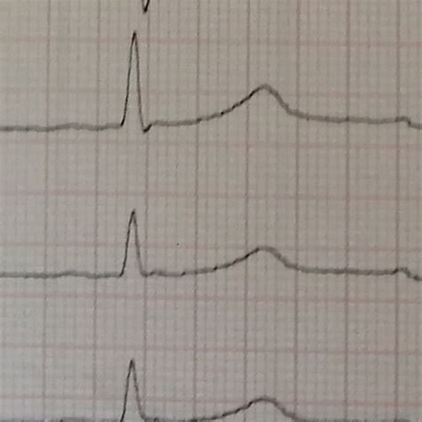 Bradycardia And Qt Interval Prolongation Because Of Hyperkalemia