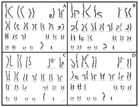 Wolf Hirschhorn Syndrome Clinical And Genetic Study Of 7 New Cases